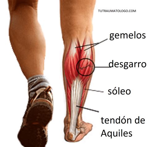 Desgarro De Gemelos Y Ruptura De Plantar Delgado