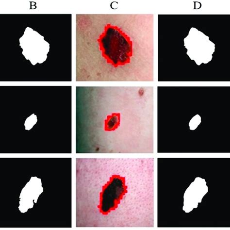Melanoma Segmentation Results Of Dermquest Dataset From The Skin With