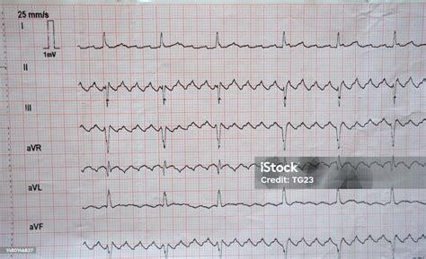 Foto De Eletrocardiograma Real Com Flutter Atrial E Mais Fotos De Stock