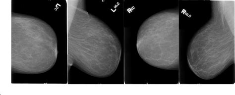 Figure 2 From Abnormality Detection In Mammography Using Deep Convolutional Neural Networks