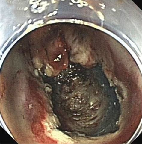 Endoscopic Submucosal Excavation Treatment For A Gastric Gist A