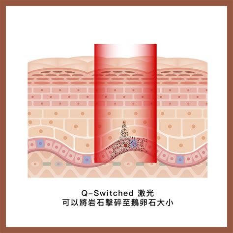 Pico Extreme 超皮秒激光 Yanis Beauty