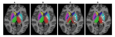 Qualitative Results For Sub Cortical Structure Segmentation A