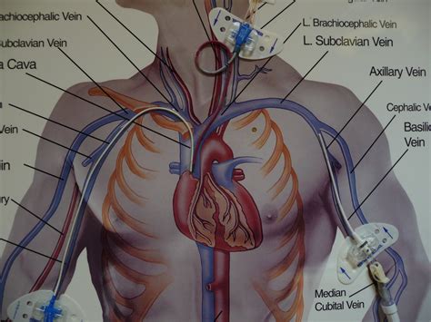 Antecubital Vein Picc Line