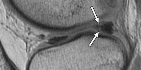 Mri Accuracy For Tears Of The Posterior Horn Of The Lateral Meniscus In
