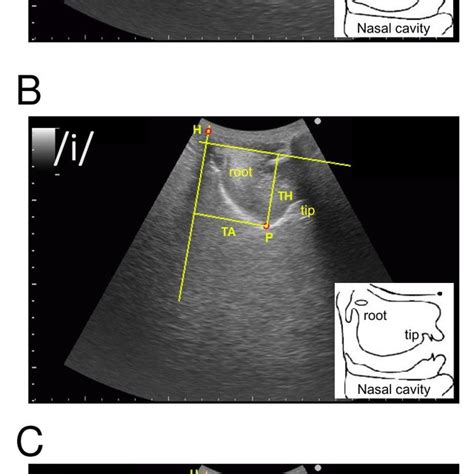 Lingual Ultrasound Images In A Healthy Adult A~c And A Case Post Download Scientific Diagram
