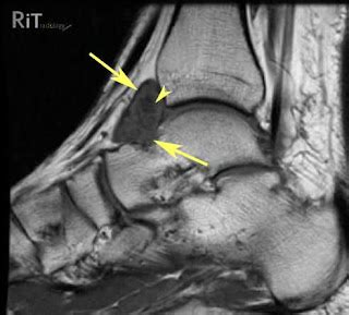 Rit Radiology Pigmented Villonodular Synovitis Pvns Of The Ankle