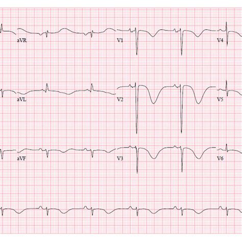 PDF Diffuse Deep T Wave Inversions Following A Generalized Seizure