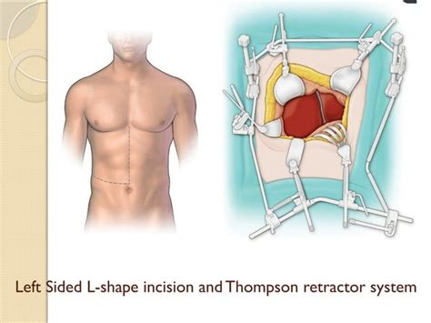 Abd Incisions Beeeeeeeeeeeeeeeeeeeeee Pptx