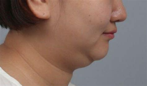 파워v얼굴지방흡입 실리프팅 이중턱근육묶기 후기 닥터정 리반의원 파워v얼굴지방흡입 실리프팅 이중턱근육묶기 후기 닥터정 리반의원