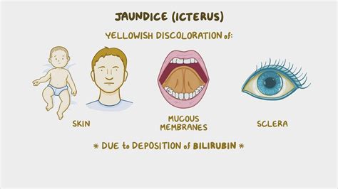 What Is Jaundice Turkey Istanbul Medical