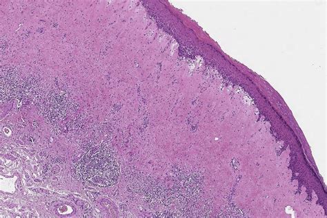 Early Lichen Sclerosus Pathology