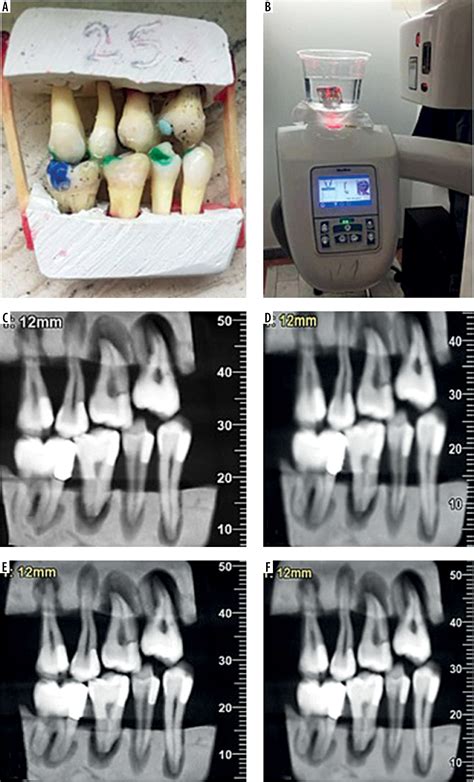 Performance Of Different Cone Beam Computed Tomography Scan Modes With And Without Metal