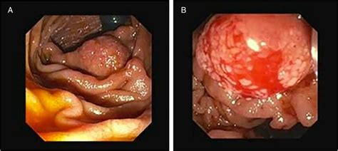 A Esophagogastroduodenoscopy Egd Shows A Deformity At The Minor