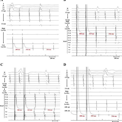 Intracardiac Electrograms Of Entrainment Pacing During The Incisional Download Scientific