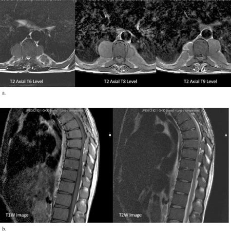 A Mri T2w Axial T6 T8 And T9 Levels B Mri T1w And T2w Thoracic Download Scientific