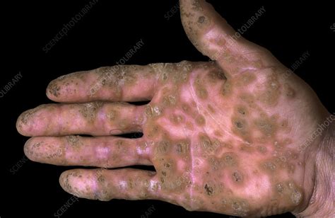 Punctate Keratosis