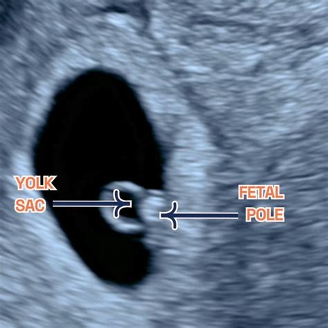 6 Week Transvaginal Ultrasound