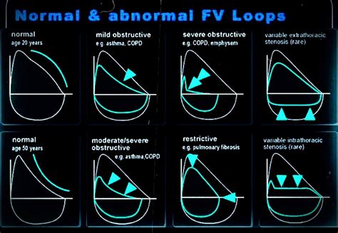 Normal And Abnormal Flow Volume Loops By Medical Sciences