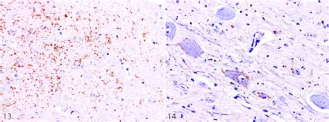 Medullaobex Nucleus Of The Solitary Tract Case No 10 Prp Sc Download Scientific Diagram