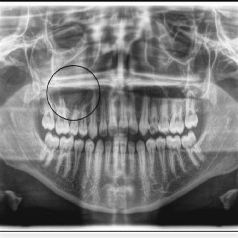 The Preoperative Panoramic Radiograph That Was Presented By The Download Scientific Diagram