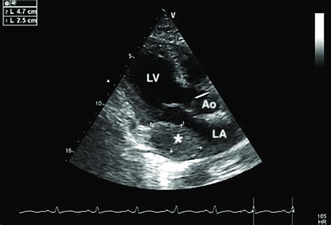 Modified Parasternal Long Axis Transthoracic Echocardiogram Download Scientific Diagram