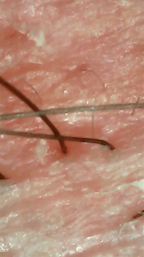 Scalp Scar Due To Lpp Or Ffa Rfemalehairloss