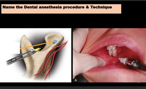 13 Mandibular Injections Flashcards Quizlet