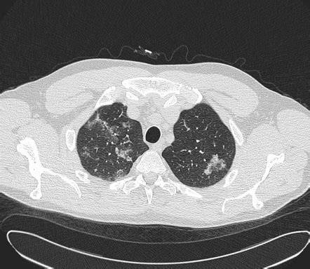 Reversed Halo Sign Lungs Radiology Reference Article