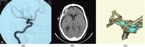 A C The Imaging Studies Of Illustrative Case 2 A Follow Up Dsa Download Scientific Diagram