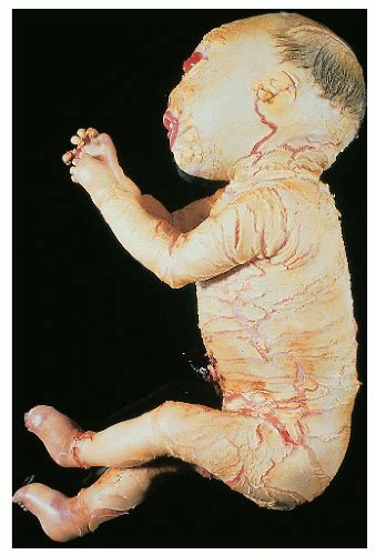 Genodermatoses Plastic Surgery Key