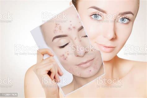 Pimpled 피부와 깨끗 한 피부 지주 초상화와 여자의 근접 촬영 초상화 사람 얼굴에 대한 스톡 사진 및 기타 이미지 사람 얼굴 피부염 가꿔주기 Istock