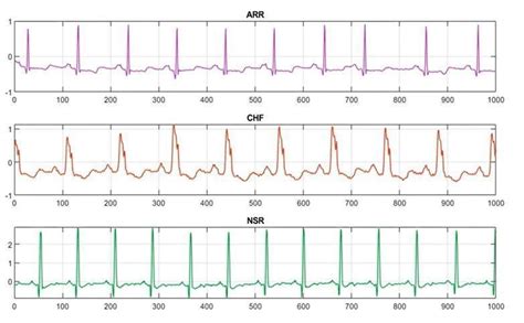 Ecg Signal Analysis Using Continuous Wavelet Transformation And Deep Neural Network By Irjet