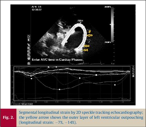 Figure 2 From Giant Congenital Left Ventricular Diverticulum Associated