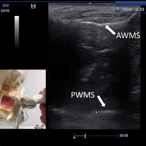 b scan us of corresponding maxillary sinus from figure 2 the osseus