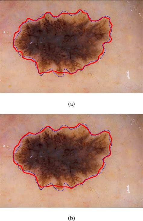 Figure 4 12 From Analysis Of Lesion Border Segmentation Using Watershed Algorithm Semantic Scholar