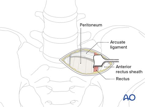 Retroperitoneal Approach For Anterior Lumbar Interbody Fusion Alif