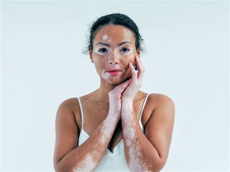 Understanding Vitiligo And What Happens Within The Skin P Healthx