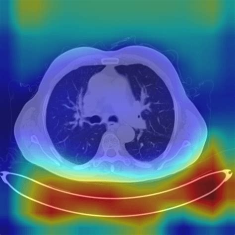 D R Research Problem About Weakly Supervised Learning For Ct Image
