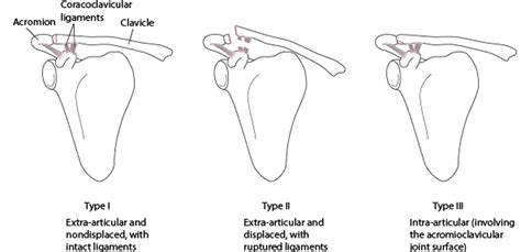 Image Class B Clavicular Fractures Msd Manual Professional Edition