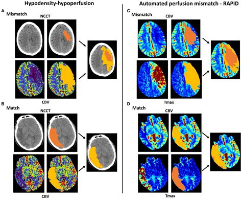 Frontiers Computed Tomography Hypoperfusion Hypodensity Mismatch Vs