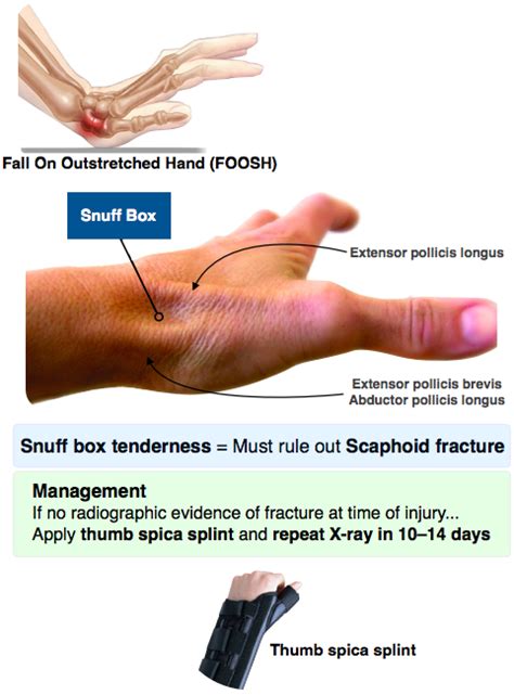 Anatomical Snuff Box Scaphoid