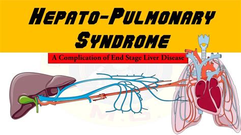 Hepatopulmonary Syndrome Etiology Pathogenesis Symptoms Diagnosis