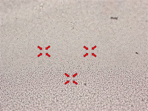 Moran Core Intraocular Lens Iol Opacification And Calcification In Patients With Hydrophilic