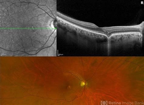 Idiopathic Choroidal Neovascularization Retina Image Bank