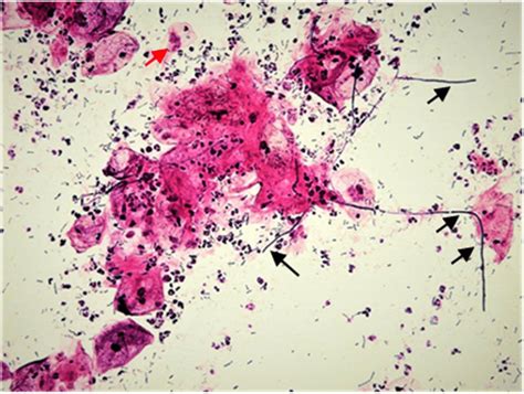 Bacterial Vaginosis Gram Stain