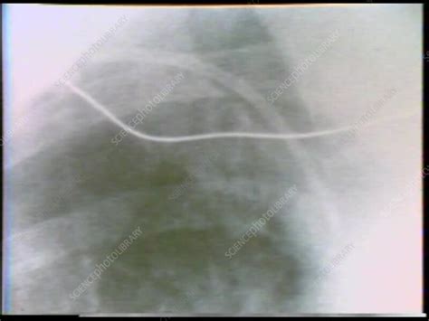 Pulmonary Artery Catheterisation X Ray Fluoroscopy Stock Video Clip K013 1928 Science