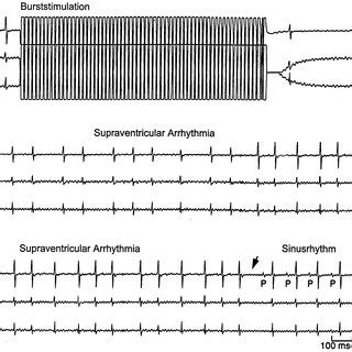 QT Intervals Measured In Vivo In Genetically Engineered Mice Download Scientific Diagram
