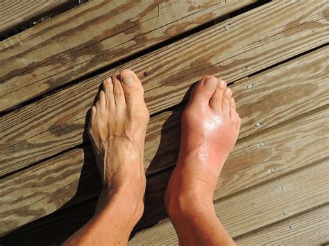 Are You Correctly Diagnosing Cellulitis
