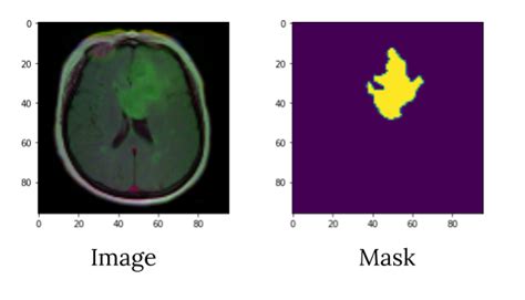 segmenting brain tumours from mri scans — 93 accuracy by shiza